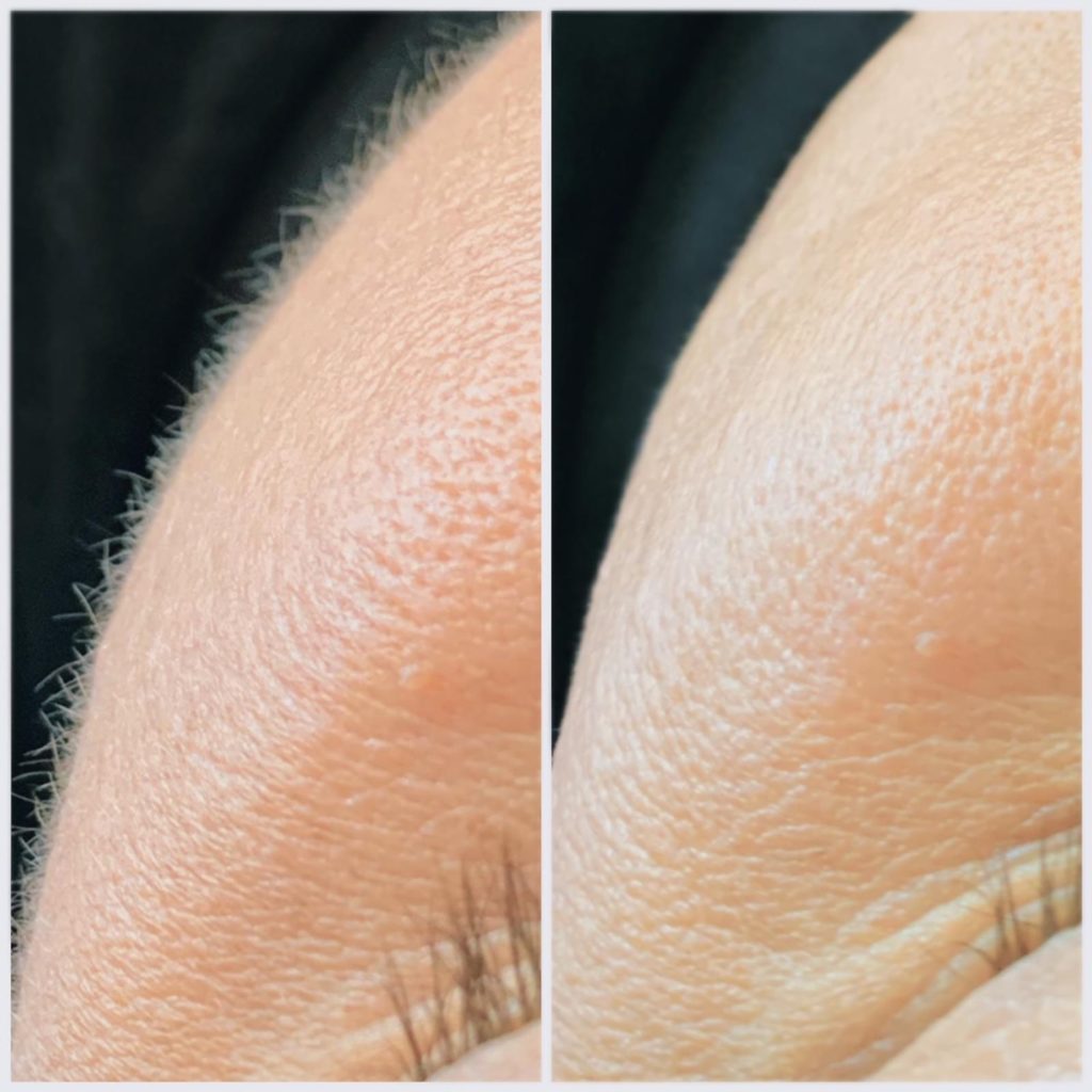 Facial Dermaplaning in Kansas City | The Facial Bar