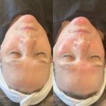 Facial Treatment in Kansas City: Bar Power Facials | The Facial Bar